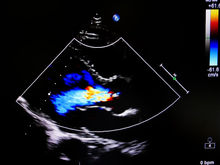 You Are Scheduled for an Echocardiogram - Here is What to Expect